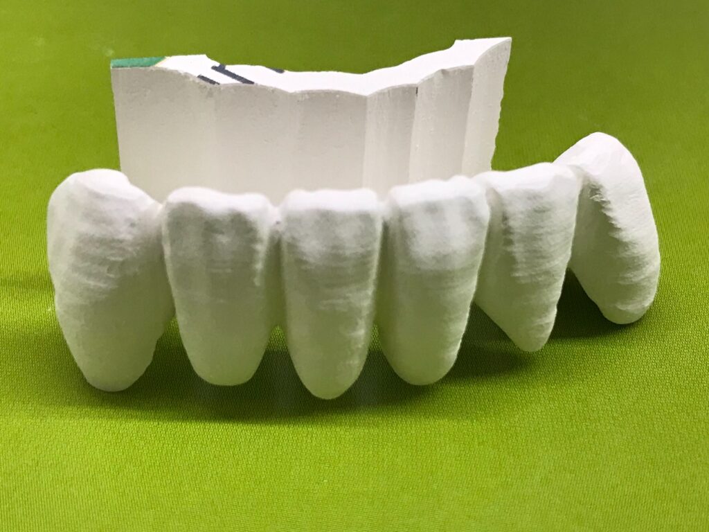 ジルコニアLUXEN Enamel Multi Gradationを使用した症例 – 歯科技工所｜Kdental