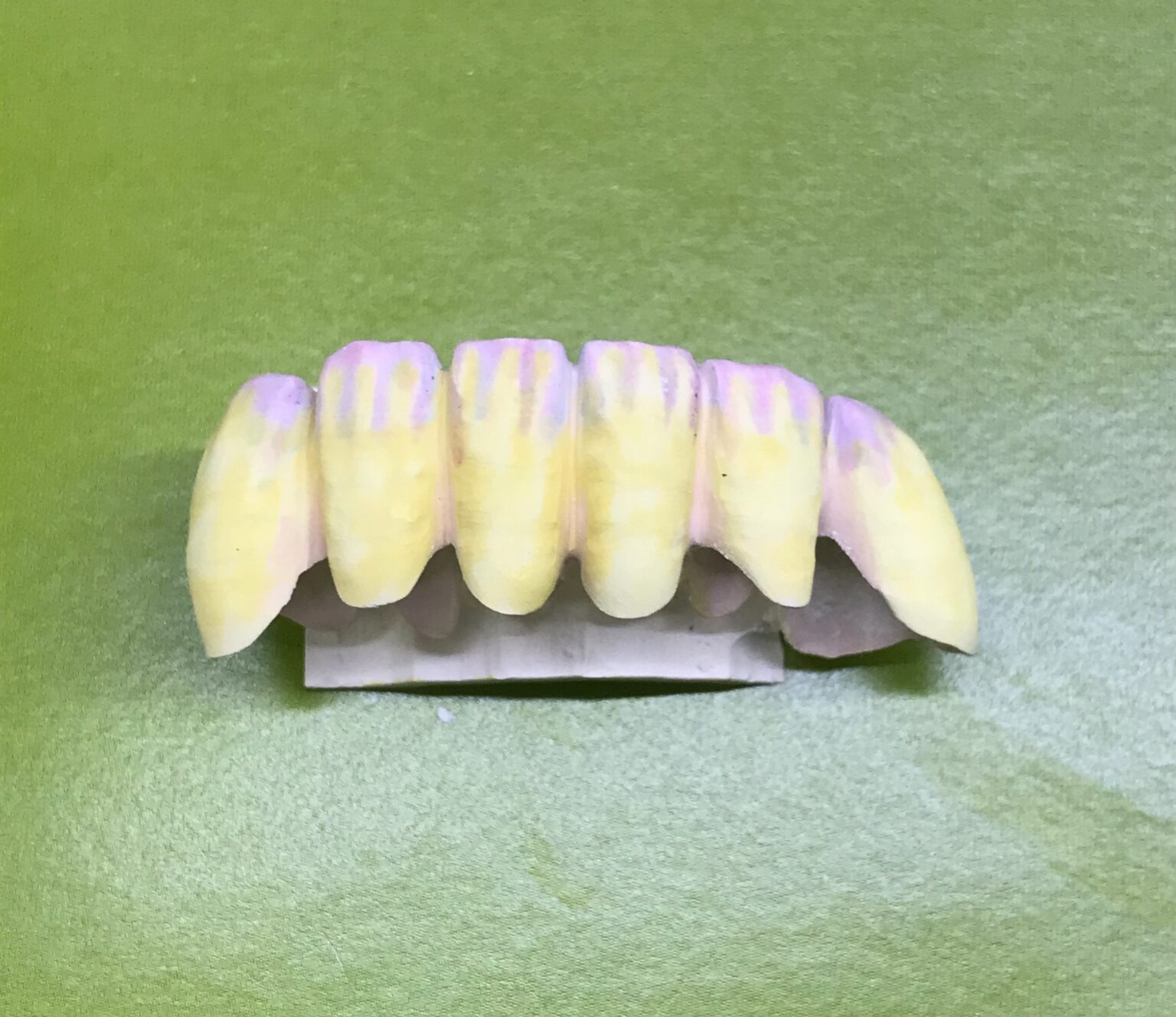 ジルコニアLUXEN Enamel Multi Gradationを使用した症例 – 歯科技工所｜Kdental